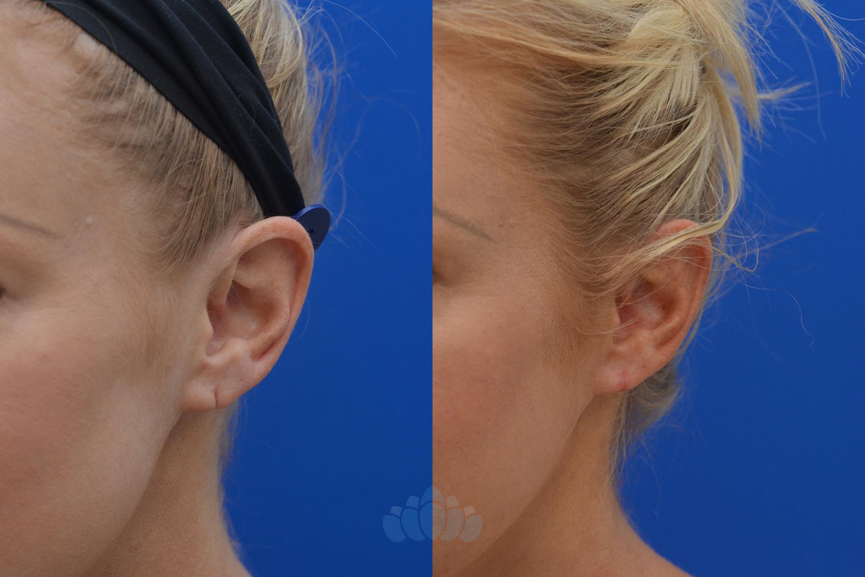 Earlobe Repair Before and After Pictures Case 53 | Charlotte, NC ...