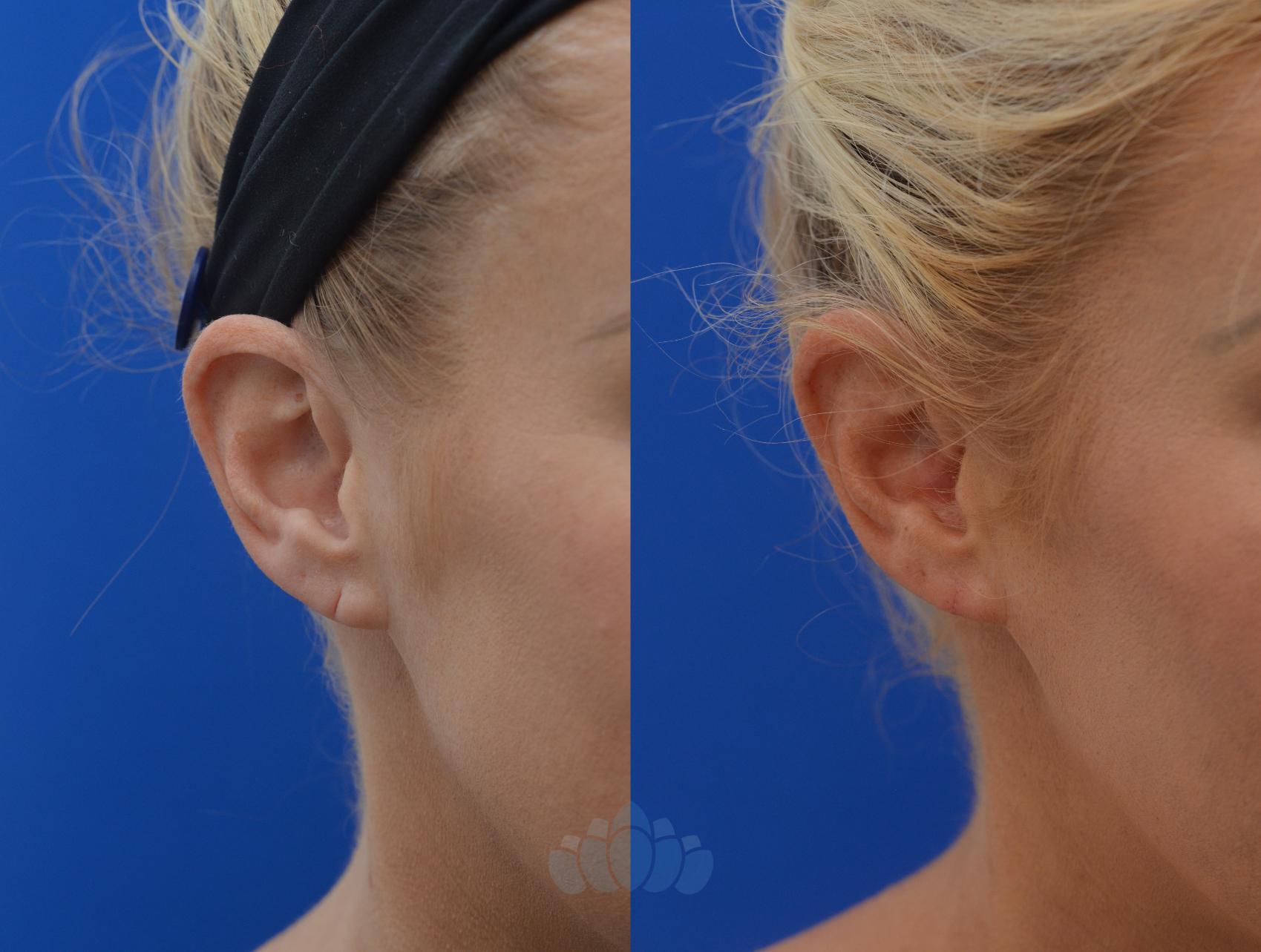 Earlobe Repair Before and After Pictures Case 53 | Charlotte, NC ...