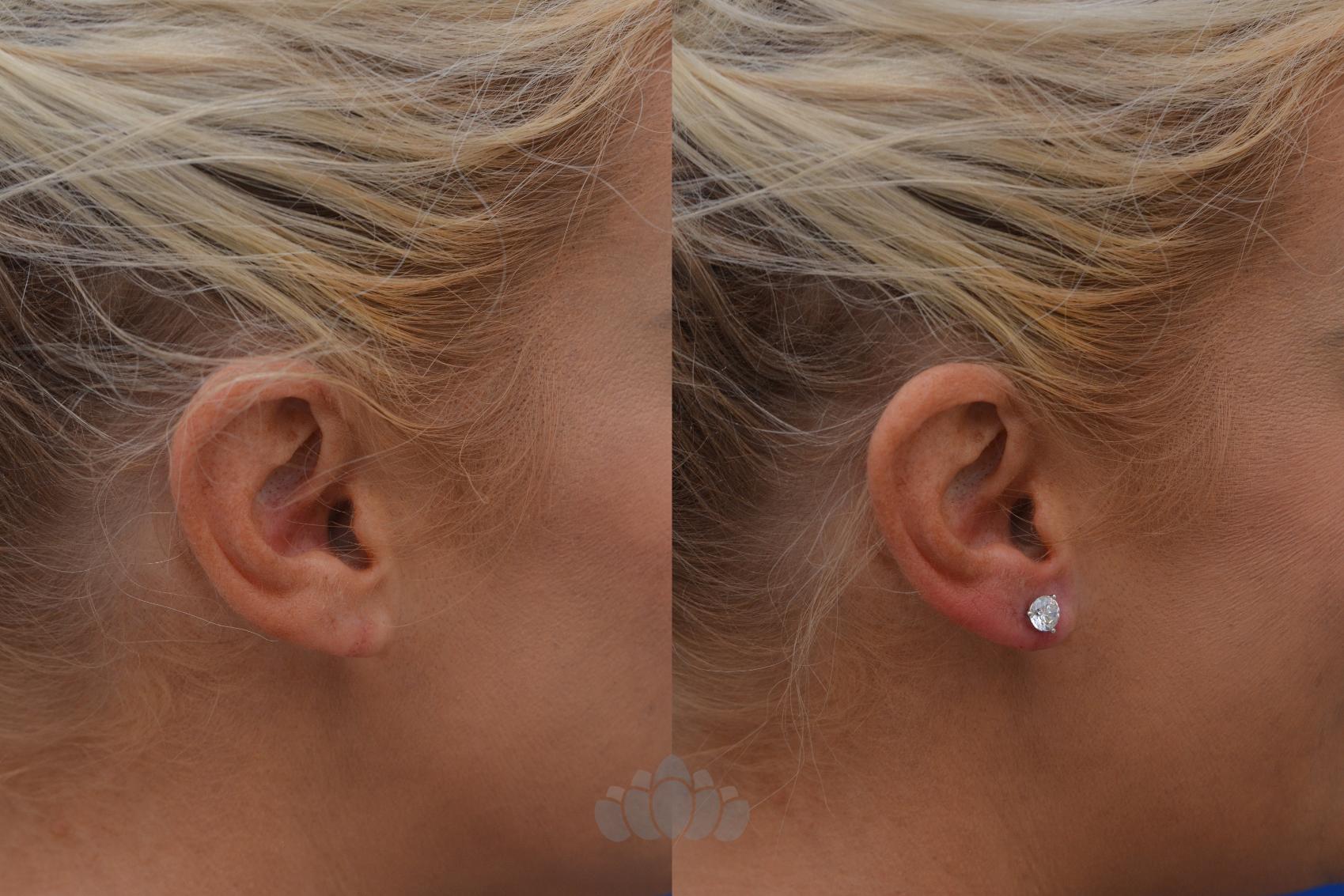 Earlobe Repair Before and After Pictures Case 53 | Charlotte, NC ...