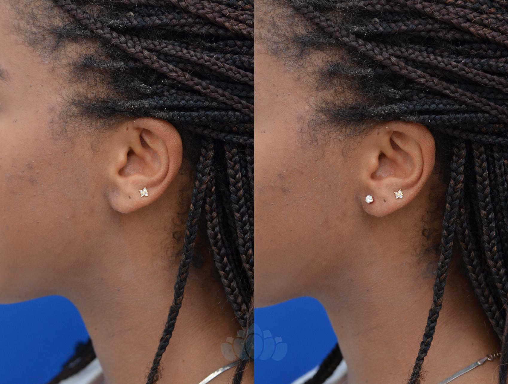 Earlobe Repair Before and After Pictures Case 54 | Charlotte, NC ...