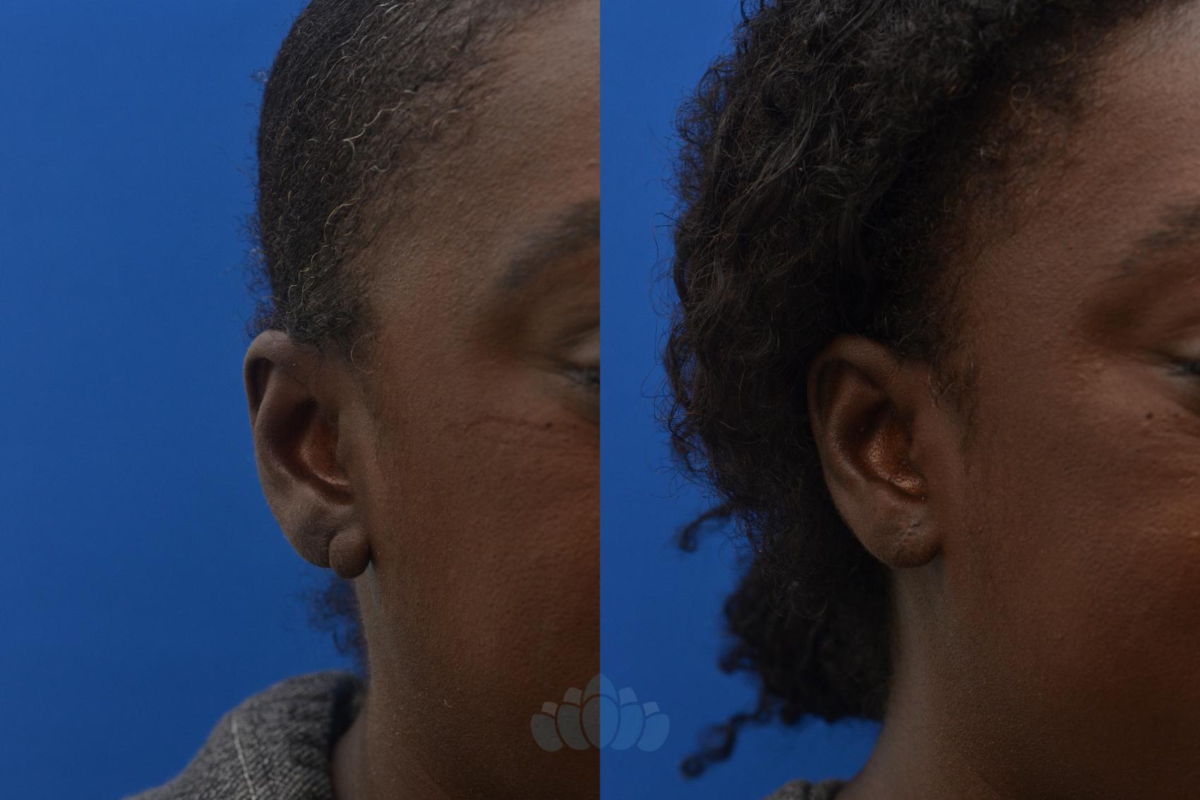 Earlobe Repair Before and After Pictures Case 55 | Charlotte, NC ...