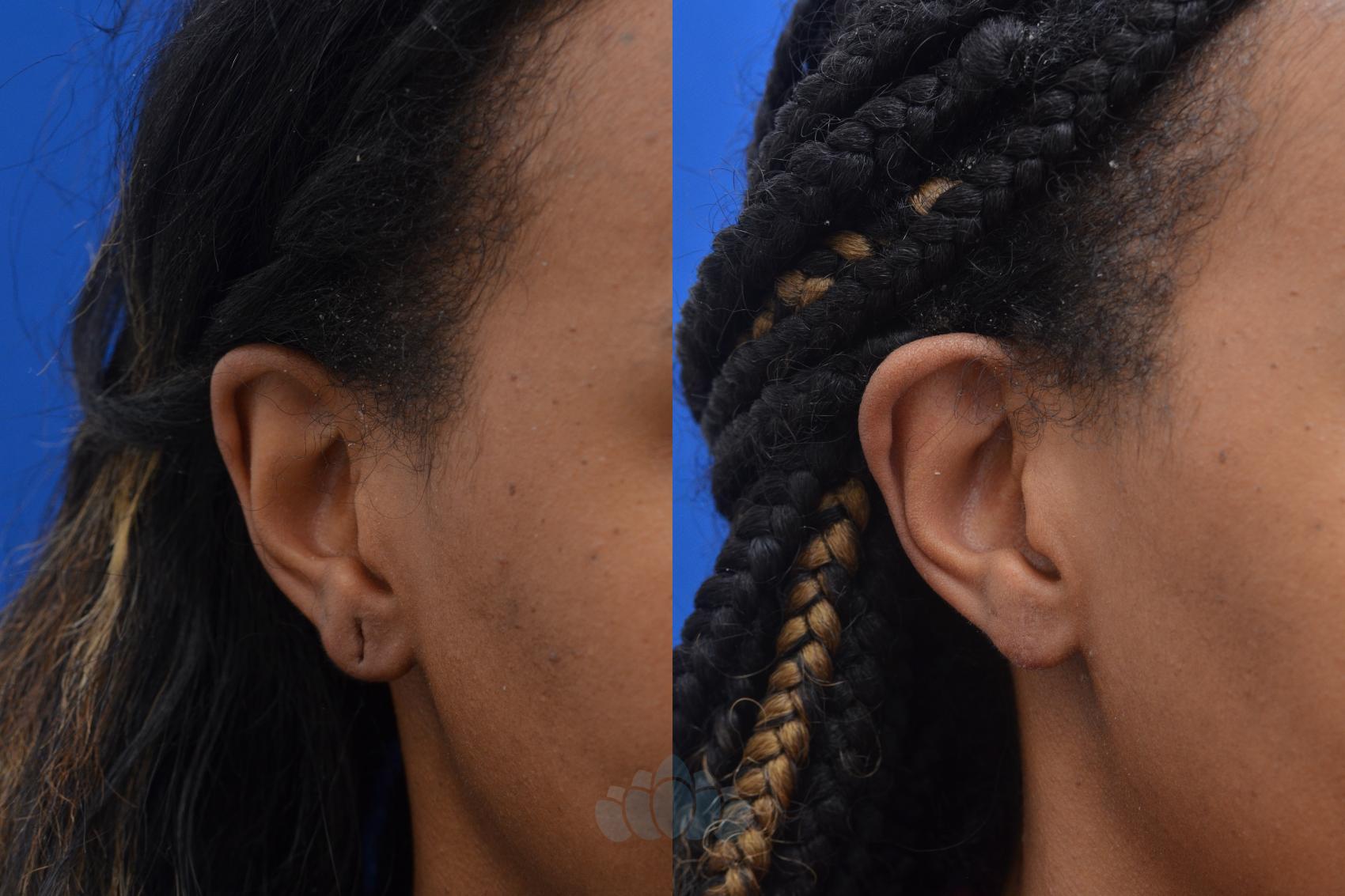 Earlobe Repair Before and After Pictures Case 56 | Charlotte, NC ...