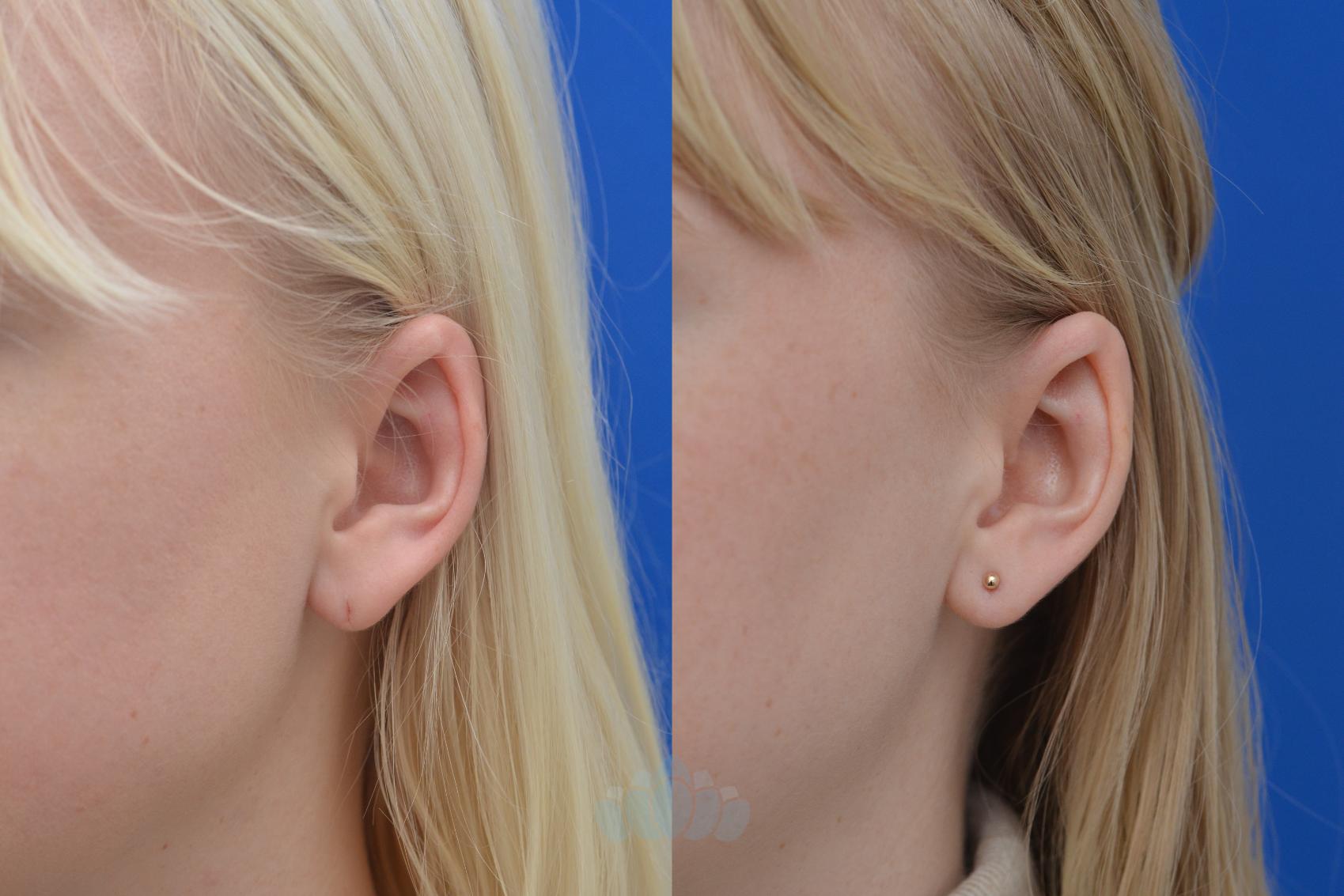 Earlobe Repair Before and After Pictures Case 57 | Charlotte, NC ...