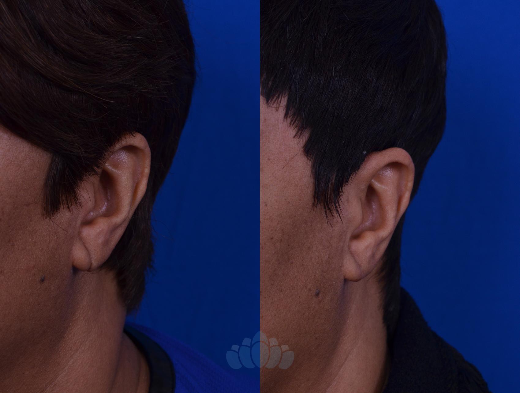 Earlobe Repair Before and After Pictures Case 59 | Charlotte, NC ...