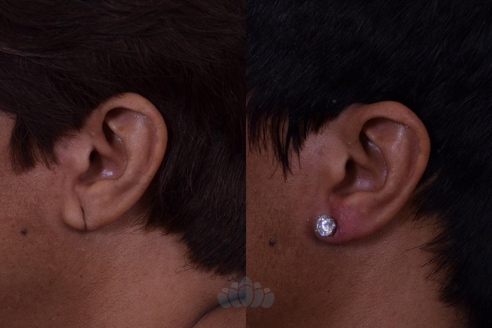 Earlobe Repair Before and After Pictures Case 59 | Charlotte, NC ...
