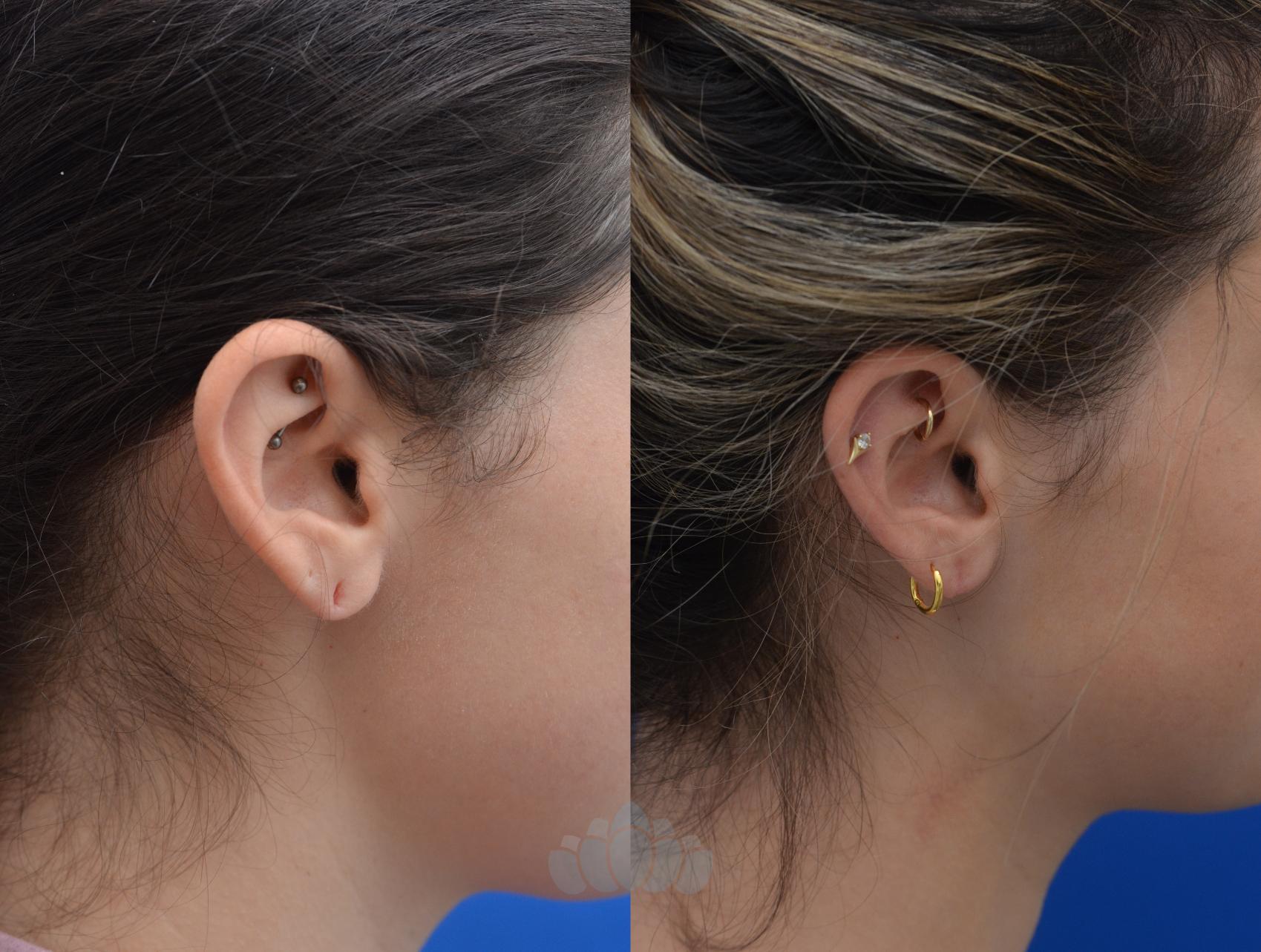 Earlobe Repair Before and After Pictures Case 77 | Charlotte, NC ...
