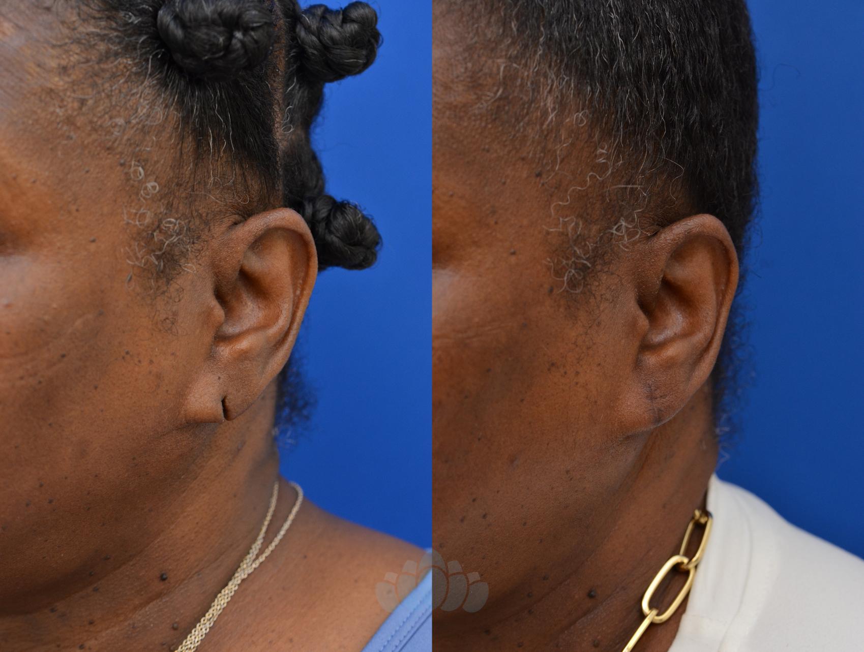 Earlobe Repair Before and After Pictures Case 78 | Charlotte, NC ...