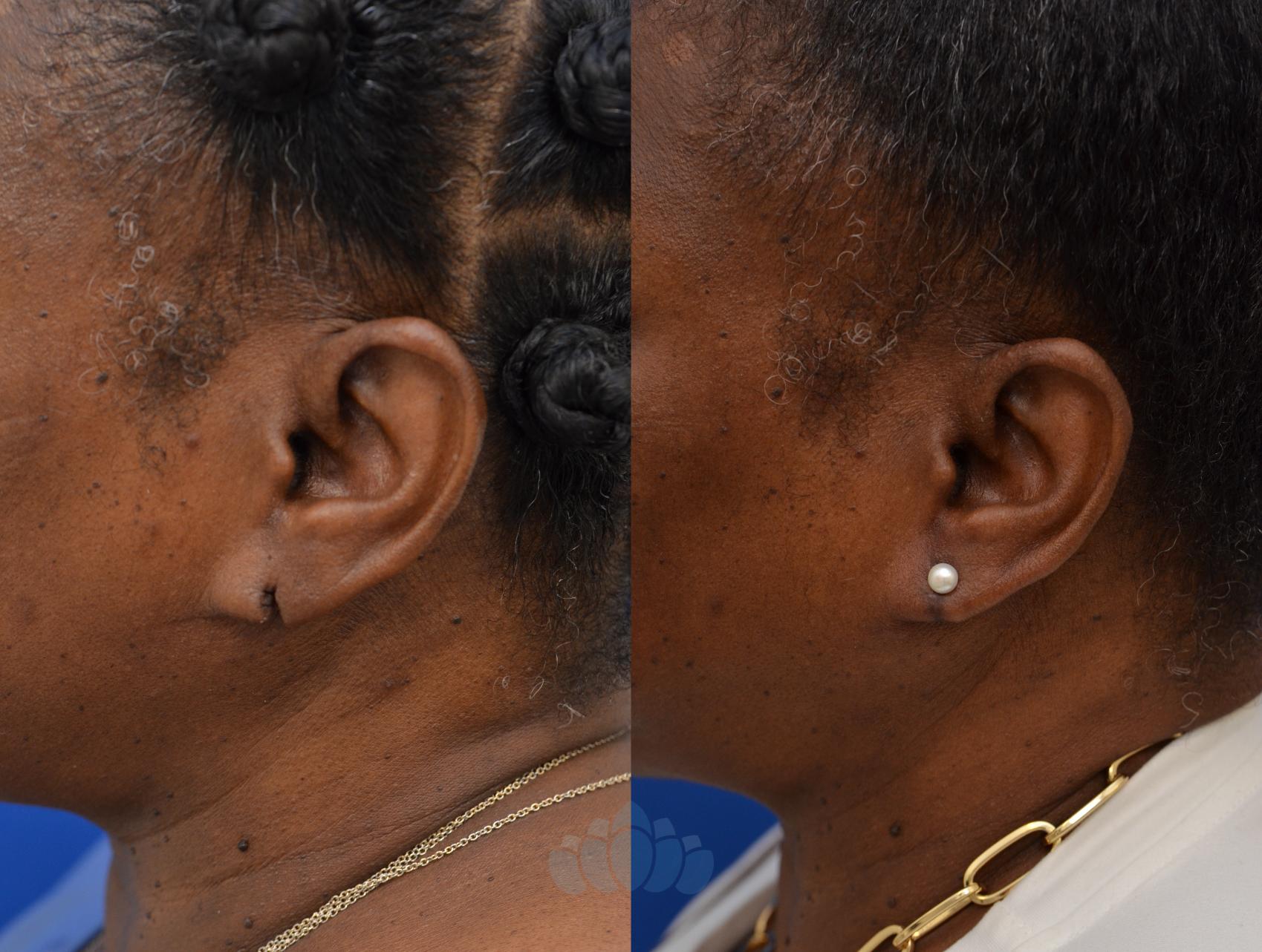 Earlobe Repair Before and After Pictures Case 78 | Charlotte, NC ...