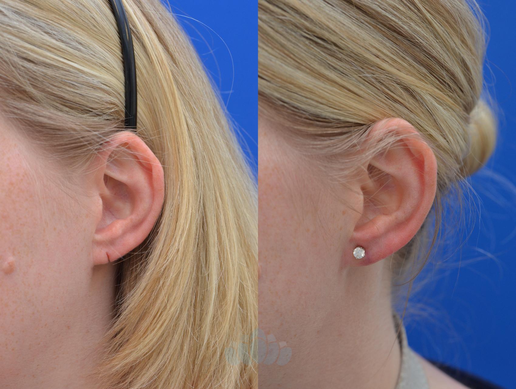 Earlobe Repair Before and After Pictures Case 79 | Charlotte, NC ...