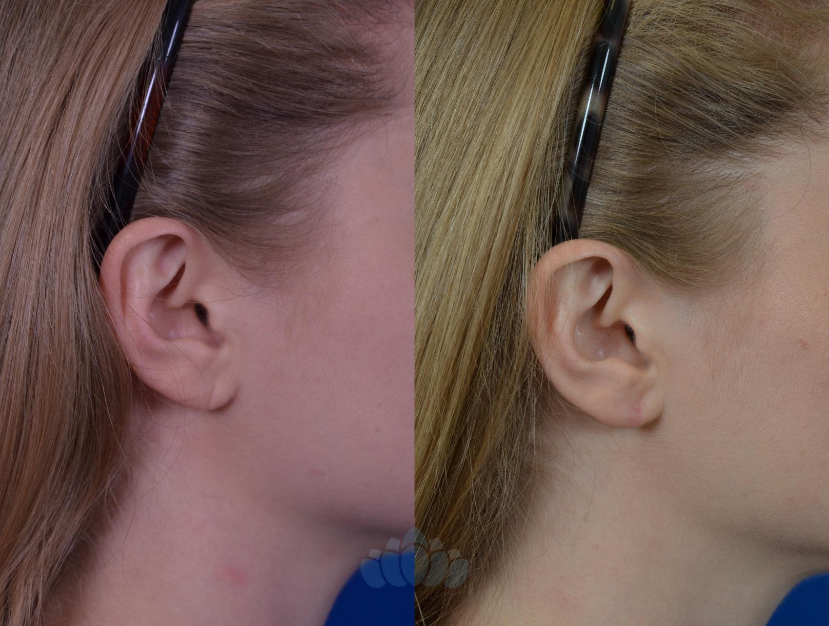 Earlobe Repair Before and After Pictures Case 82 | Charlotte, NC ...