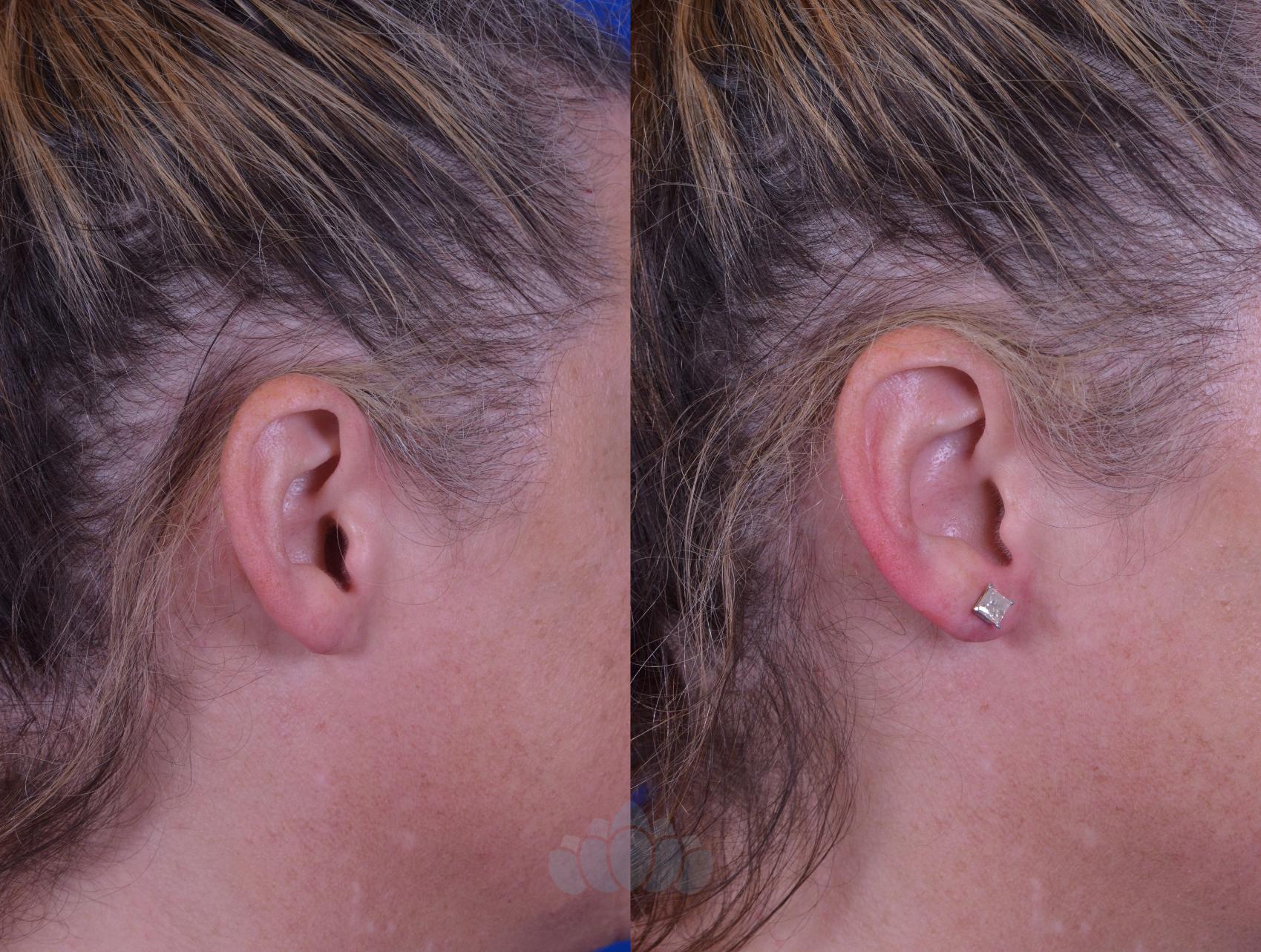 Earlobe Repair Before and After Pictures Case 83 | Charlotte, NC ...