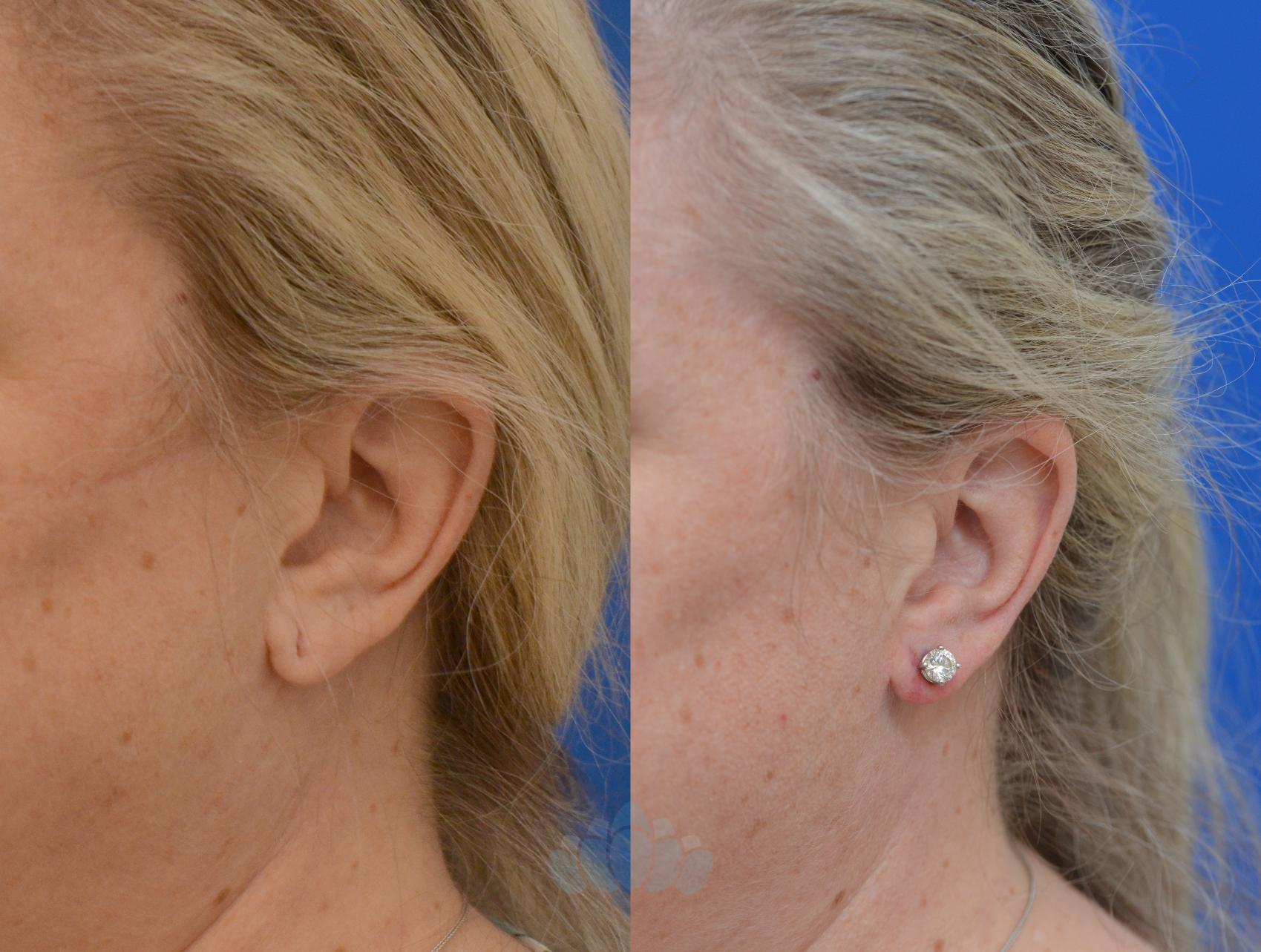 Earlobe Repair Before and After Pictures Case 85 | Charlotte, NC ...