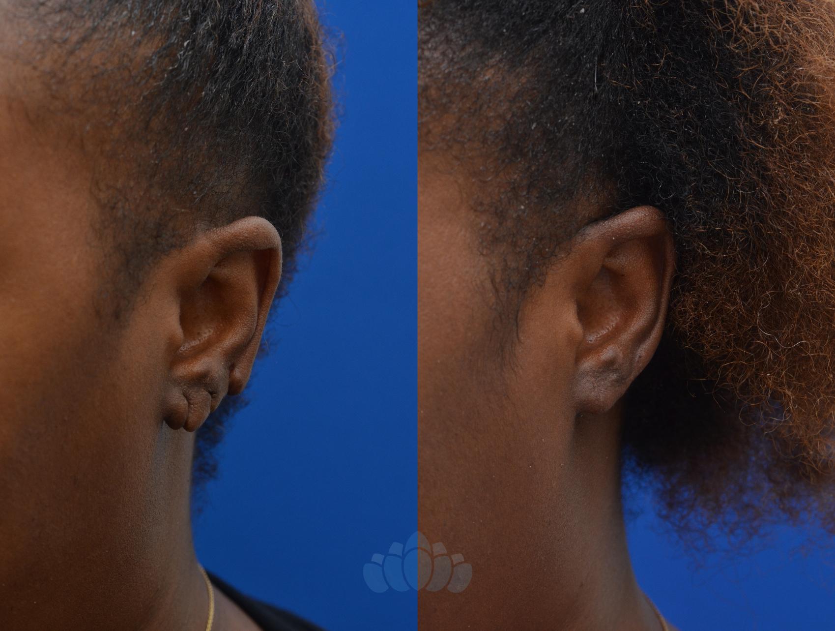 Earlobe Repair Before and After Pictures Case 86 | Charlotte, NC ...