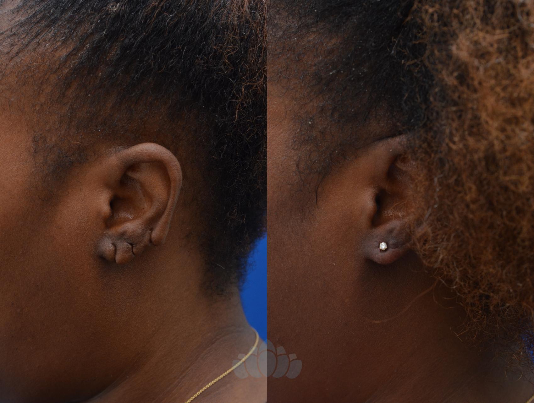 Earlobe Repair Before and After Pictures Case 86 | Charlotte, NC ...