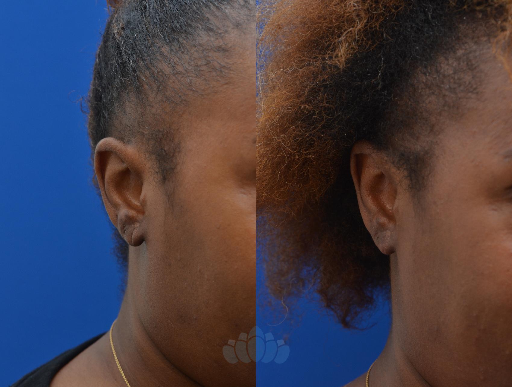 Earlobe Repair Before and After Pictures Case 86 | Charlotte, NC ...