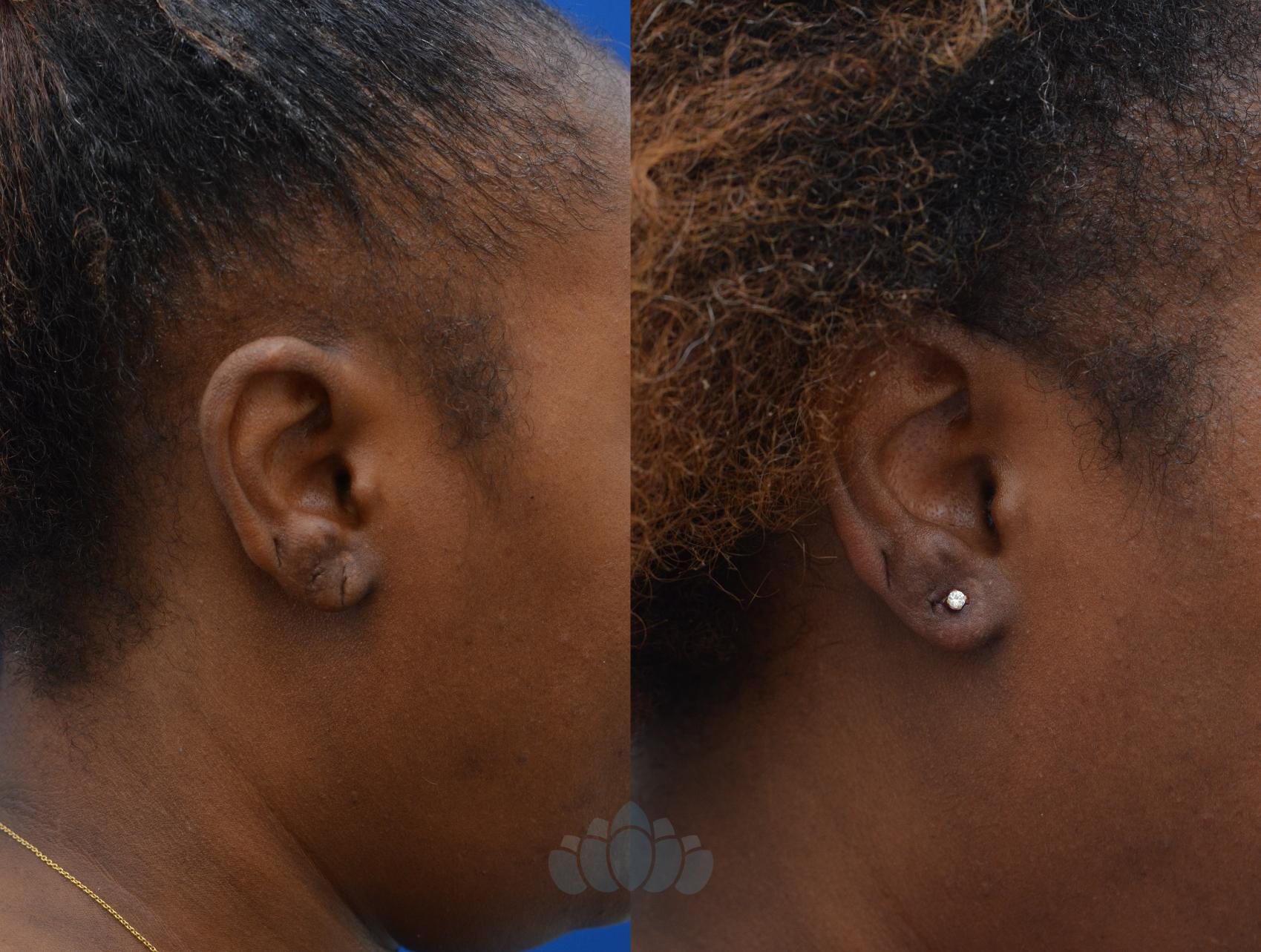 Earlobe Repair Before and After Pictures Case 86 | Charlotte, NC ...