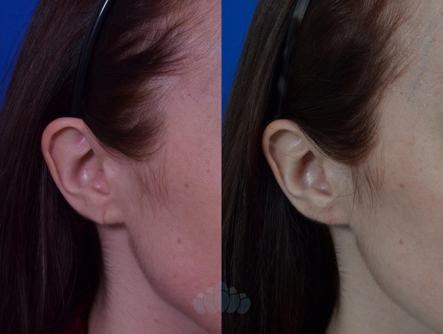 Earlobe Repair Before and After Pictures Case 87 | Charlotte, NC ...