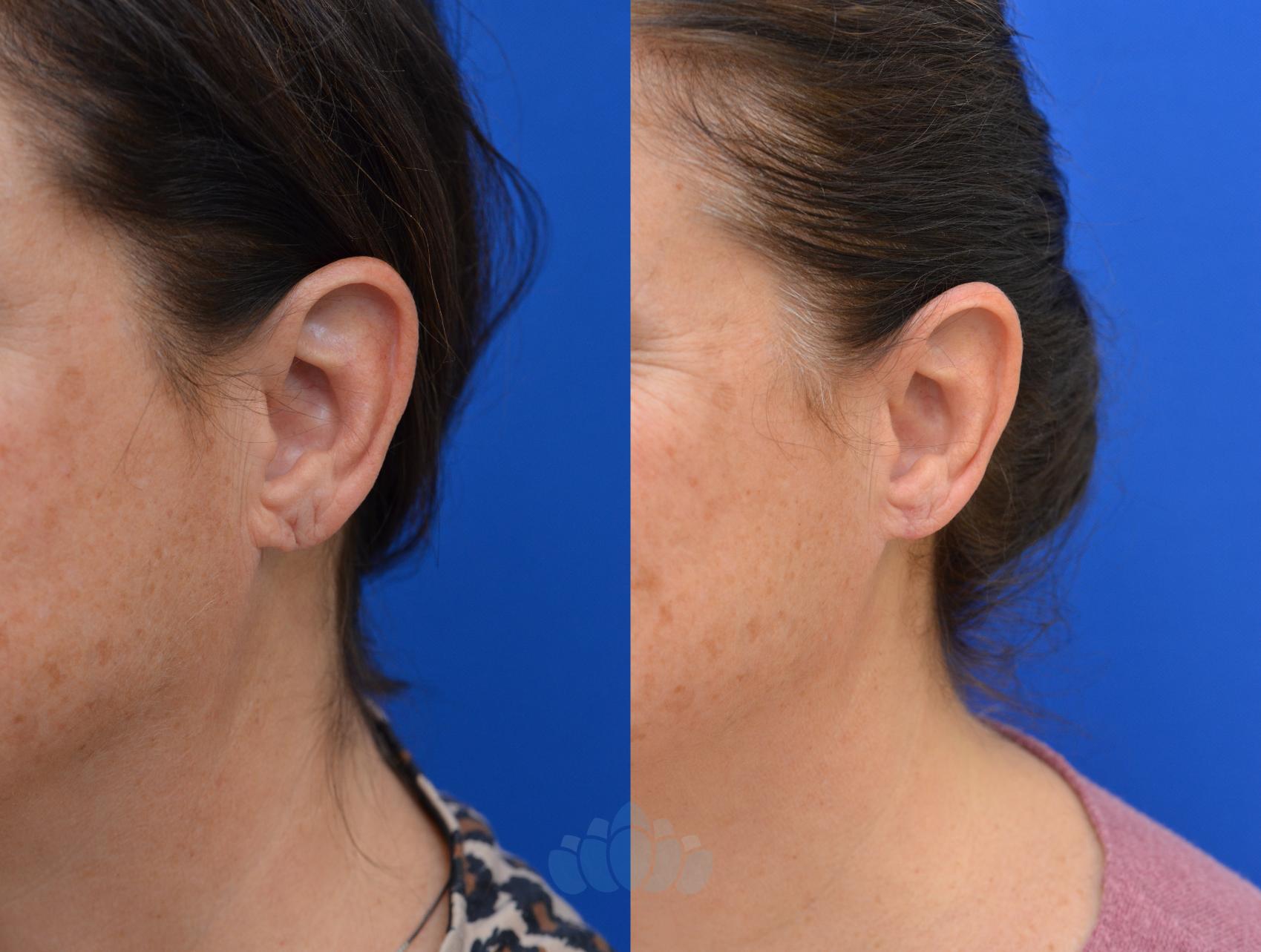 Earlobe Repair Before and After Pictures Case 88 | Charlotte, NC ...