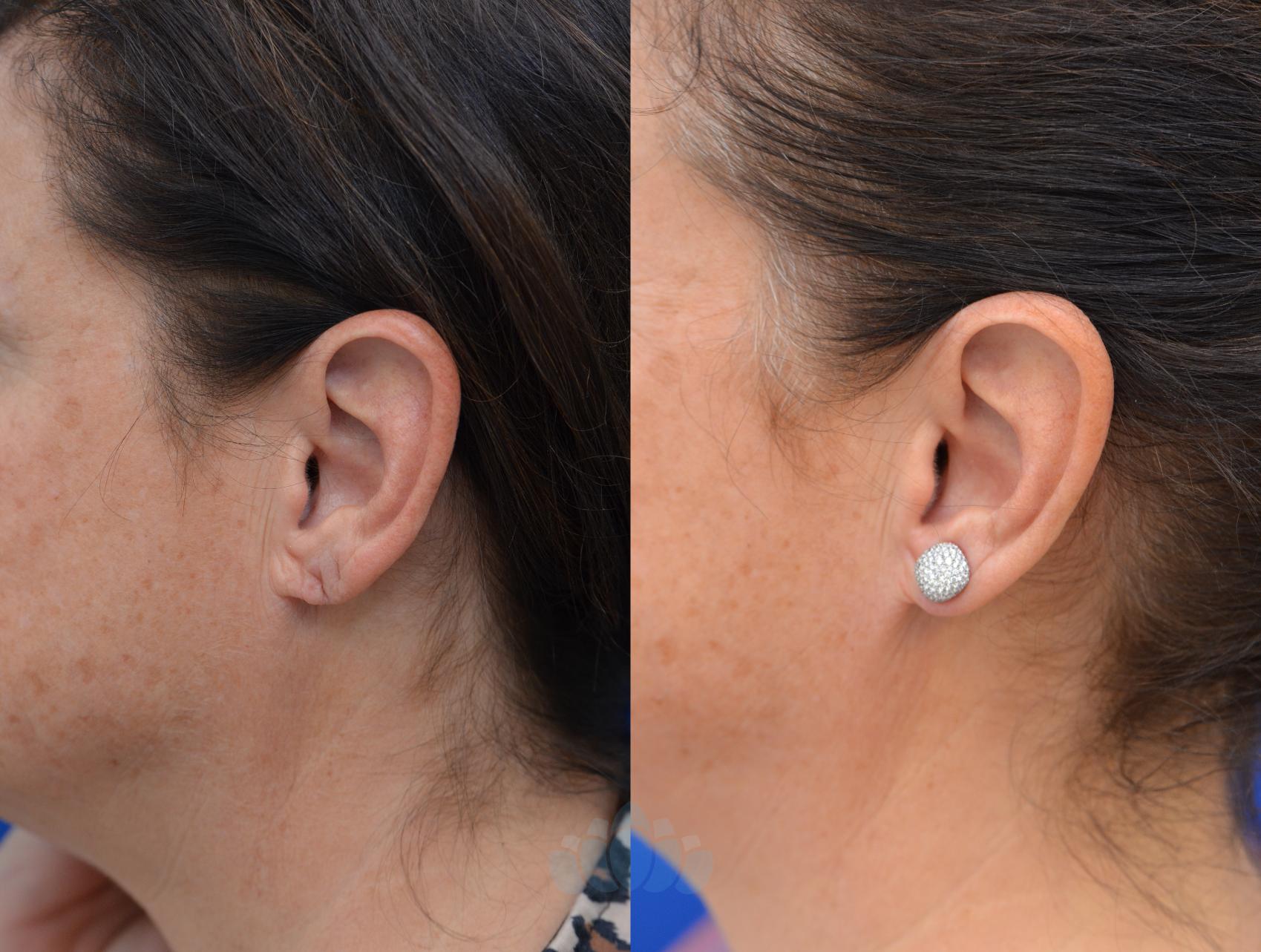 Earlobe Repair Before and After Pictures Case 88 | Charlotte, NC ...