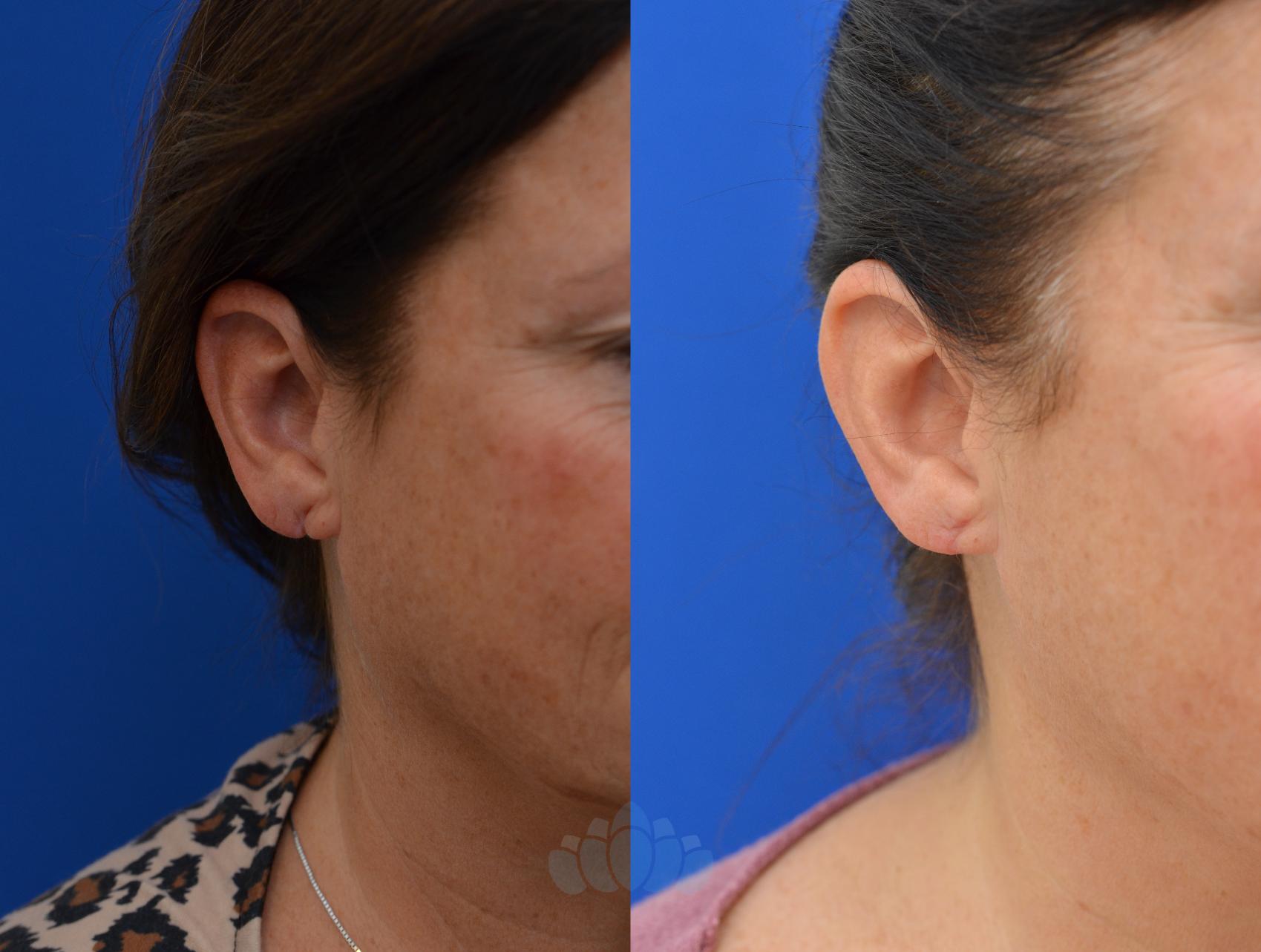 Earlobe Repair Before and After Pictures Case 88 | Charlotte, NC ...