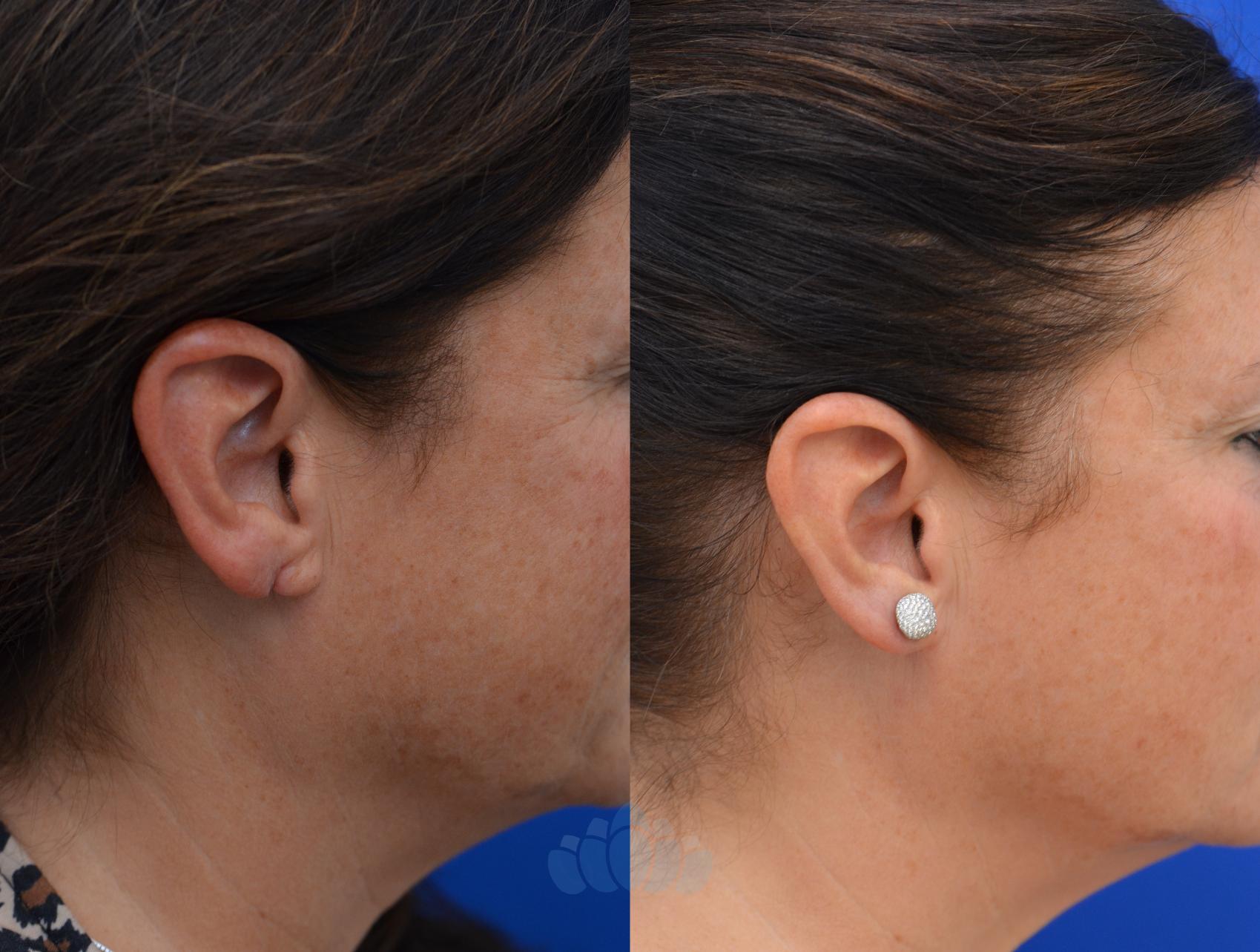 Earlobe Repair Before and After Pictures Case 88 | Charlotte, NC ...
