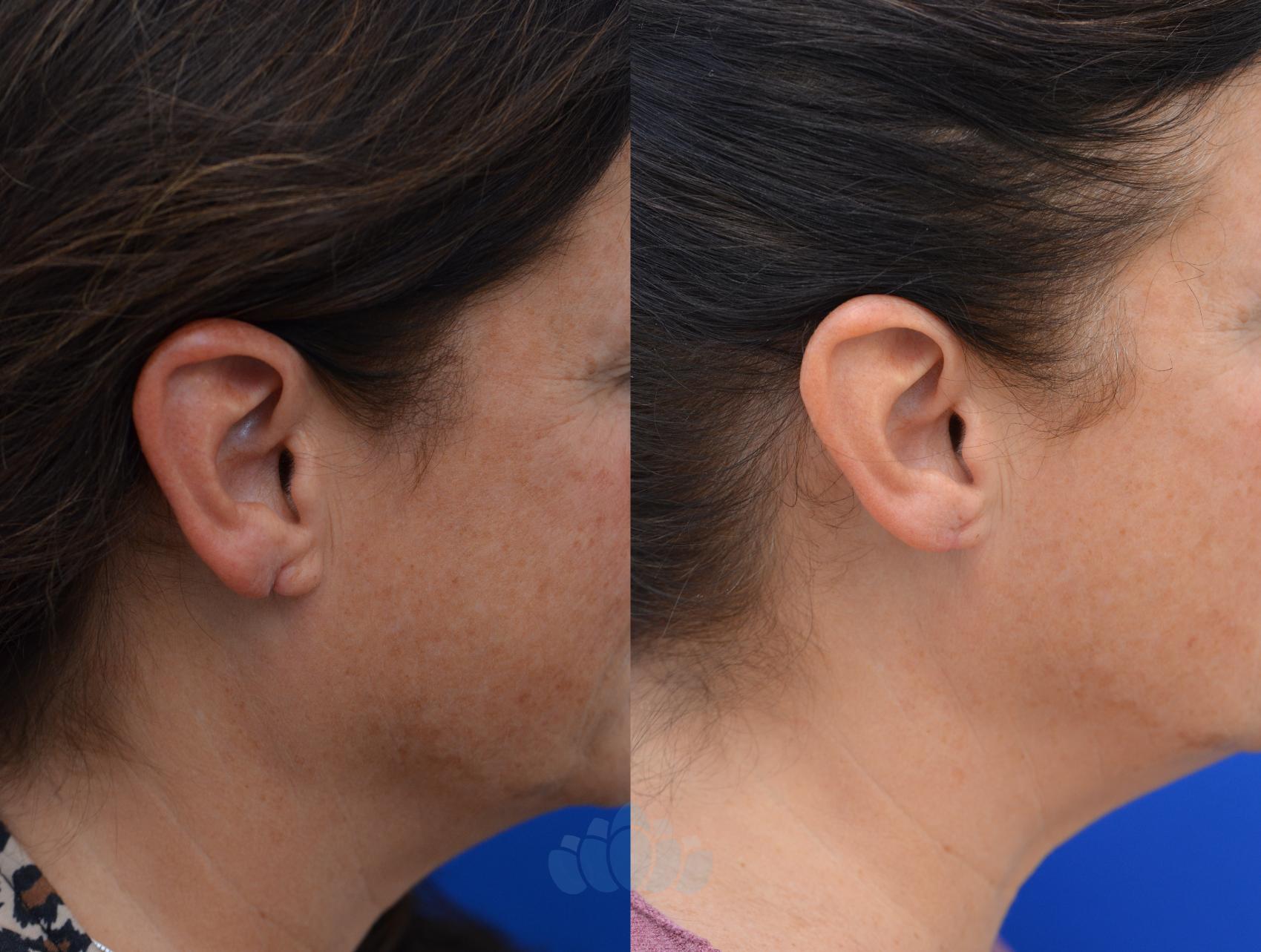 Earlobe Repair Before and After Pictures Case 88 | Charlotte, NC ...