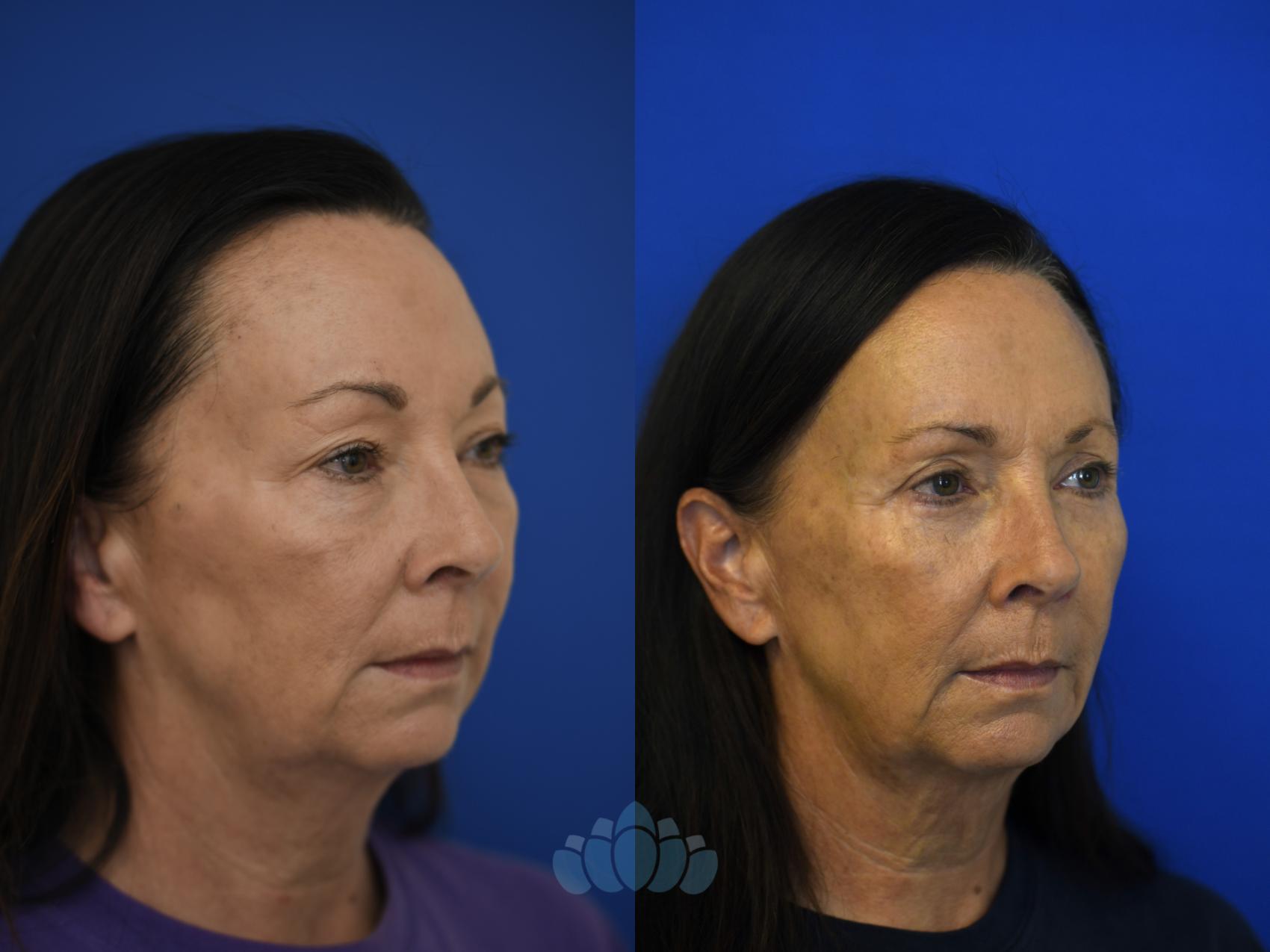 Eyelid Surgery Before And After Pictures Case 96 Charlotte Nc