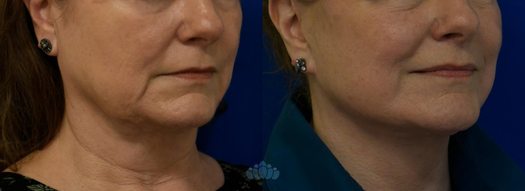Facelift Before and After Pictures Case 112 | Charlotte, NC | Dilworth ...