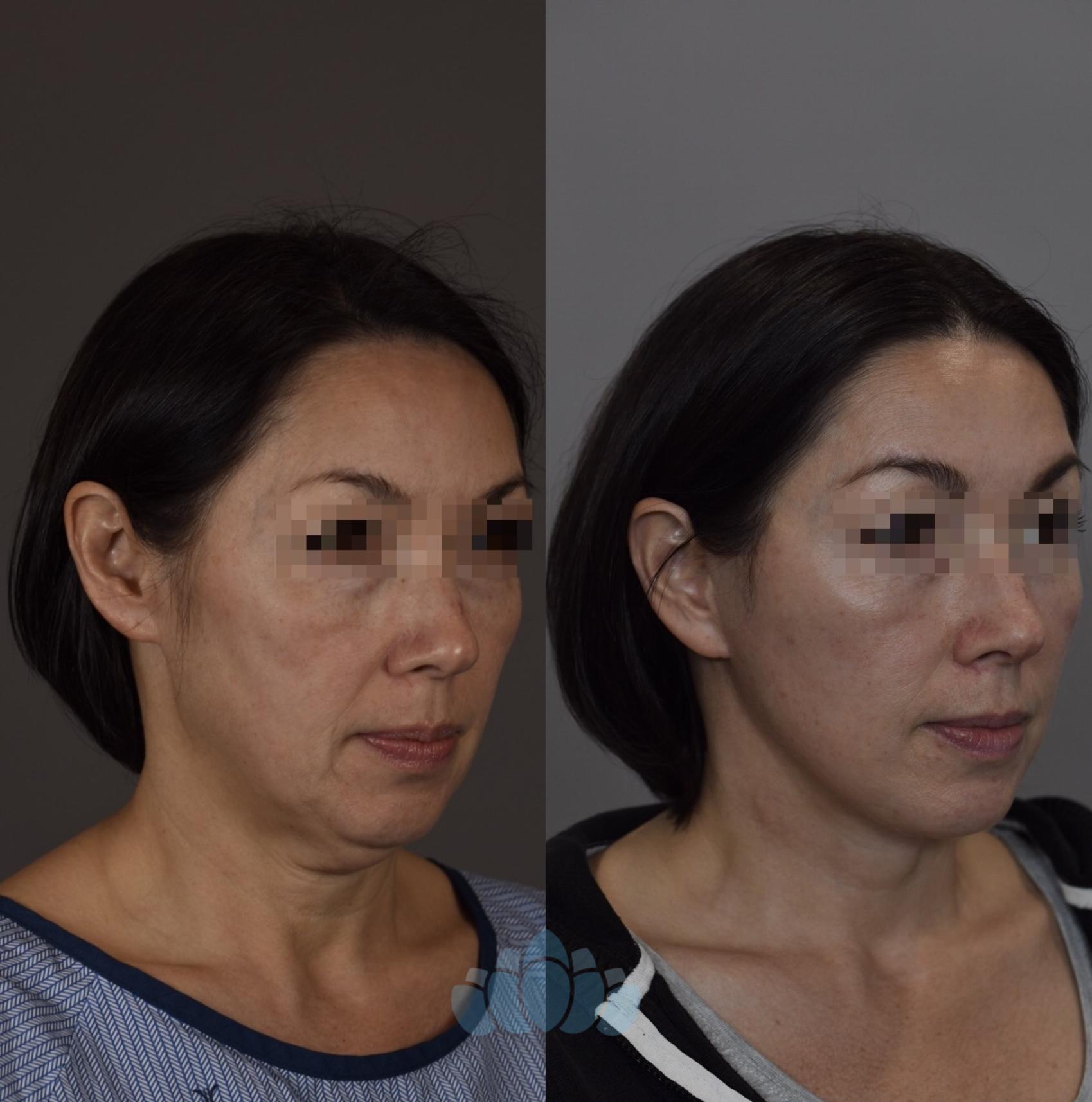 Facelift Before and After Pictures Case 93 | Charlotte, NC | Dilworth ...
