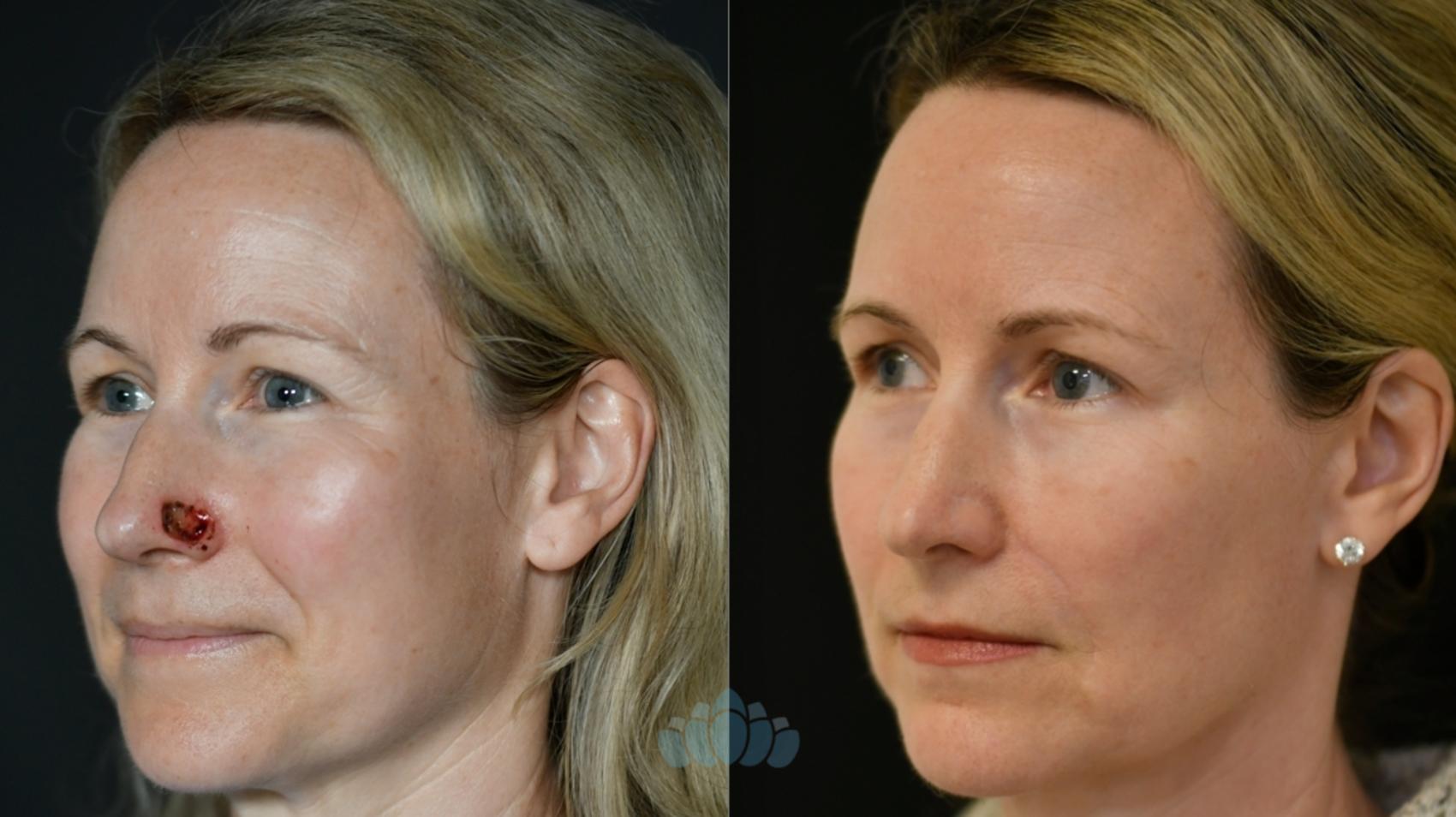 Mohs & Skin Cancer Surgery Before and After Pictures Case 118 | Charlotte, NC | Dilworth Facial ...
