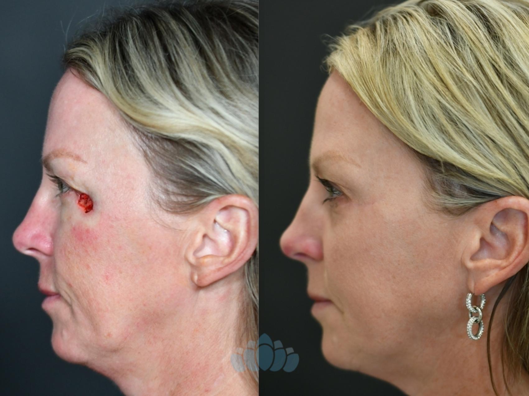 Mohs & Skin Cancer Surgery Before and After Pictures Case 121 | Charlotte, NC | Dilworth Facial ...