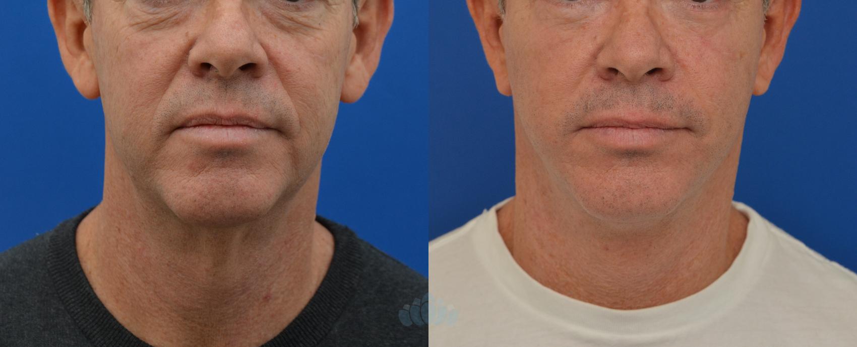 Neck Lift Before and After Pictures Case 13 | Charlotte, NC | Dilworth ...