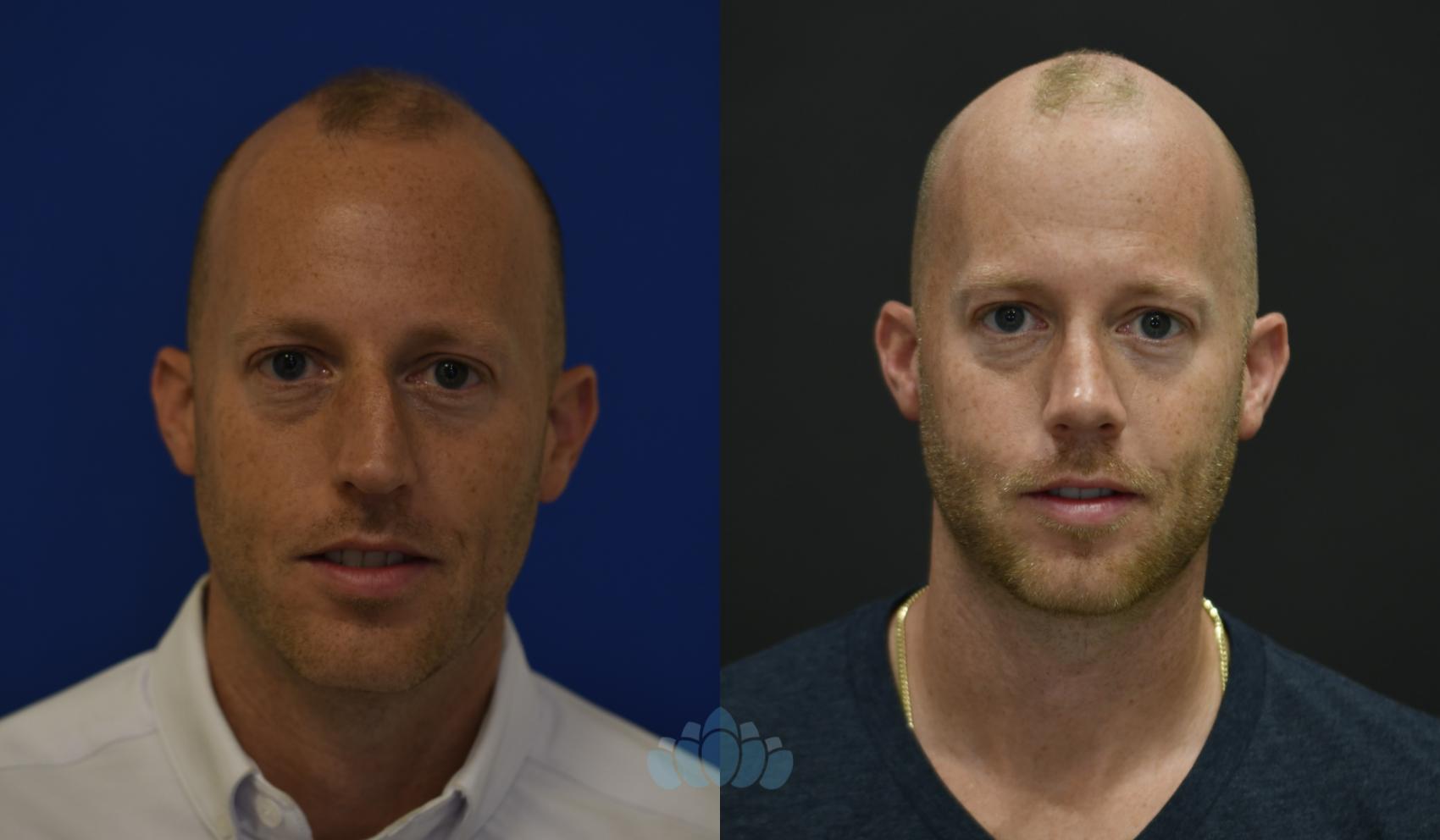 Rhinoplasty Before and After Pictures Case 106 | Charlotte, NC ...