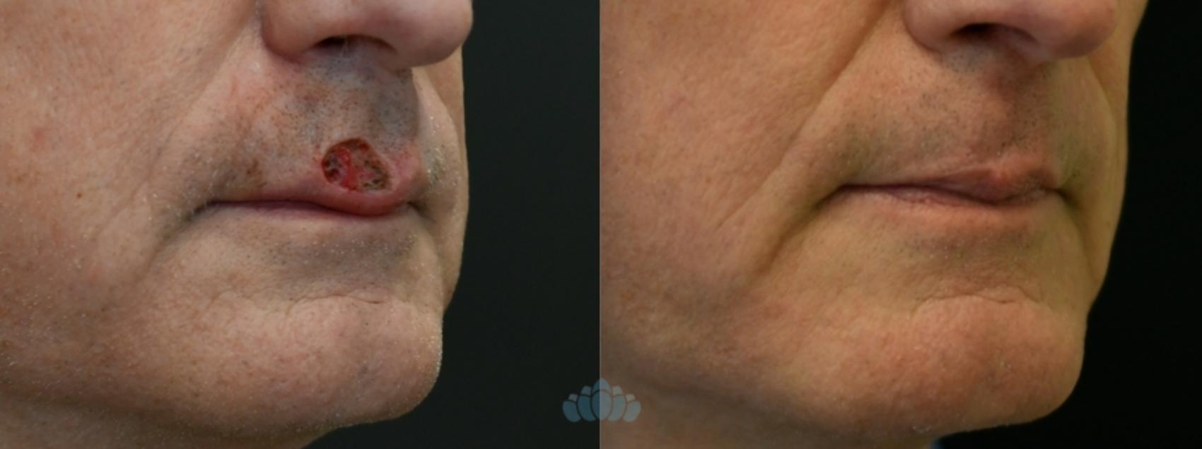 Skin Cancer Reconstruction after Mohs Surgery Before and After Pictures ...