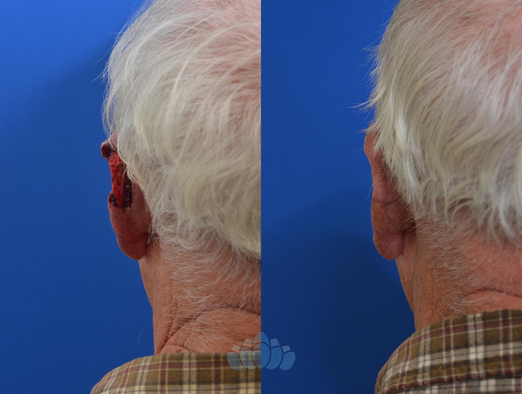 Skin Cancer Reconstruction after Mohs Surgery Before and After Pictures ...